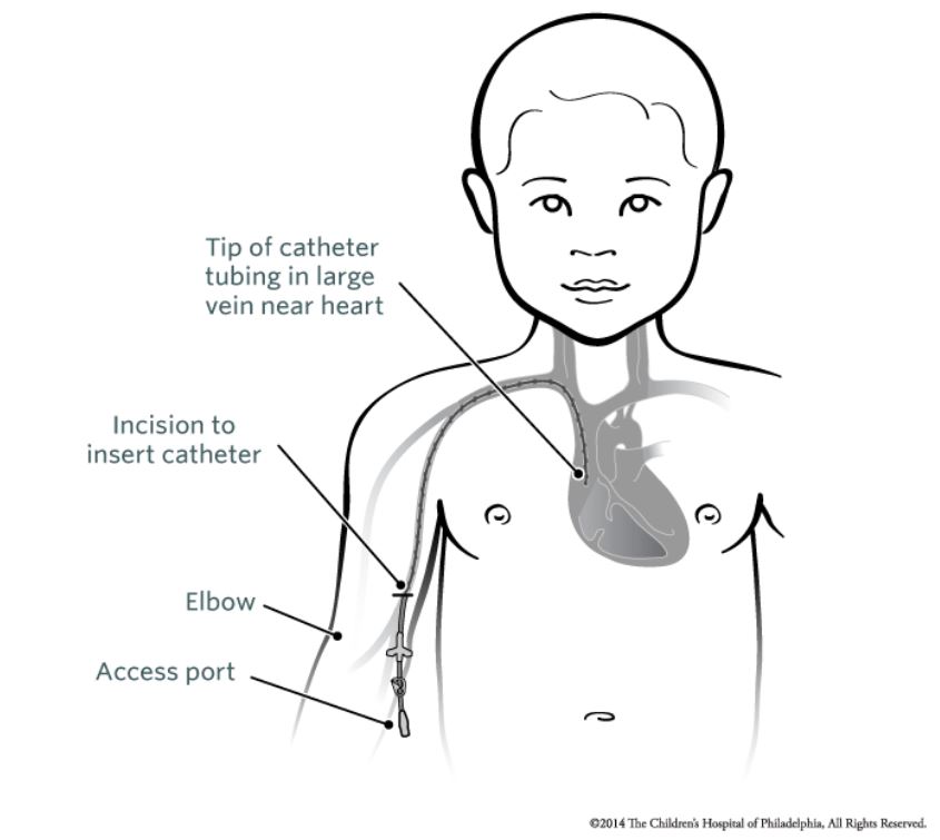 PICC(말초삽입 중심정맥관)