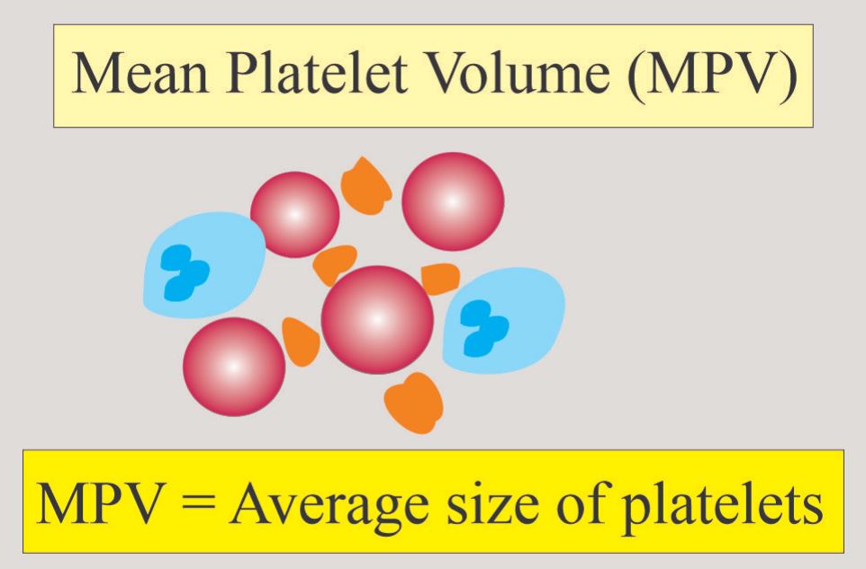 MPV(Mean Platelet Volume) 수치와 임상적 의의