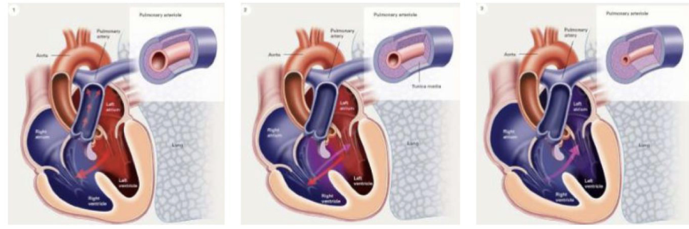 Pulmonary Artery Hypertan sion 폐동맥 고혈압 PAH, - a8