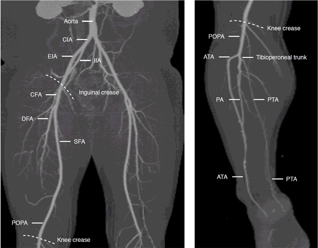 [PTA] Lower extremity arteries Intervention