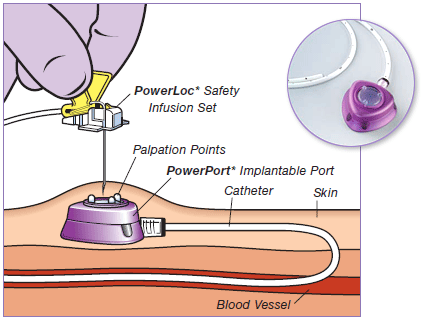 매립형 중심정맥관(Implanted Port): 케모포트(Chemoport)