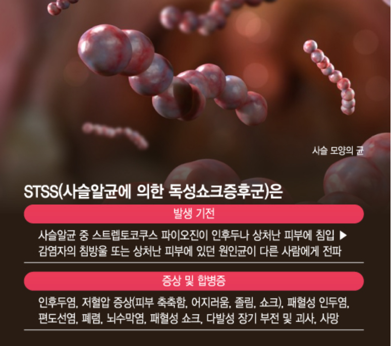 일본 전염병 STSS 치사율 및 국내 확산 가능성은?