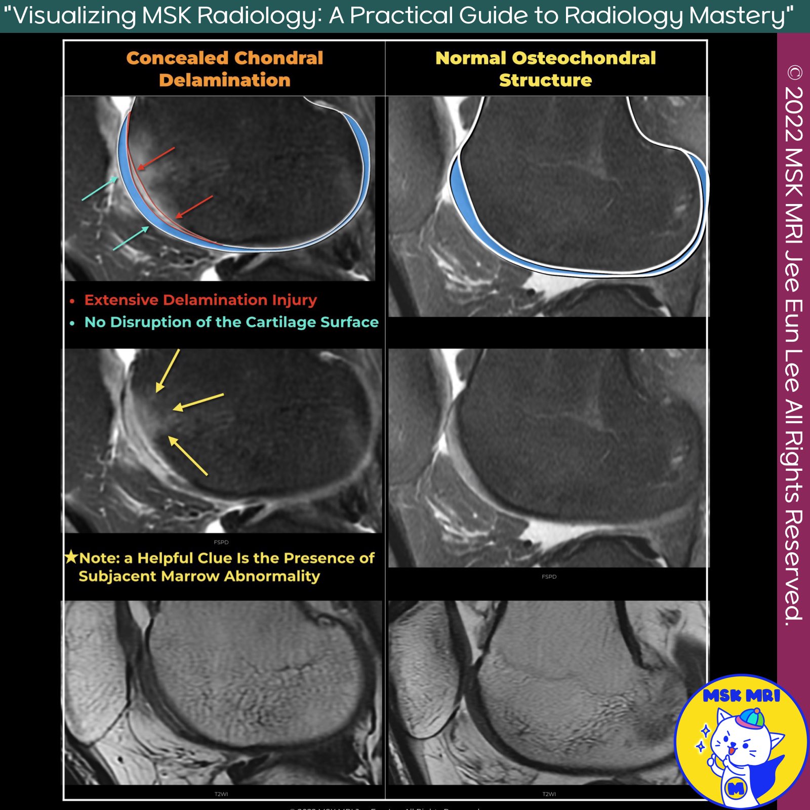 (Fig 5-A.15) Concealed Chondral Delamination
