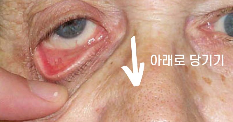 눈밑 지방 재배치 가격, 하안검 수술과 차이점