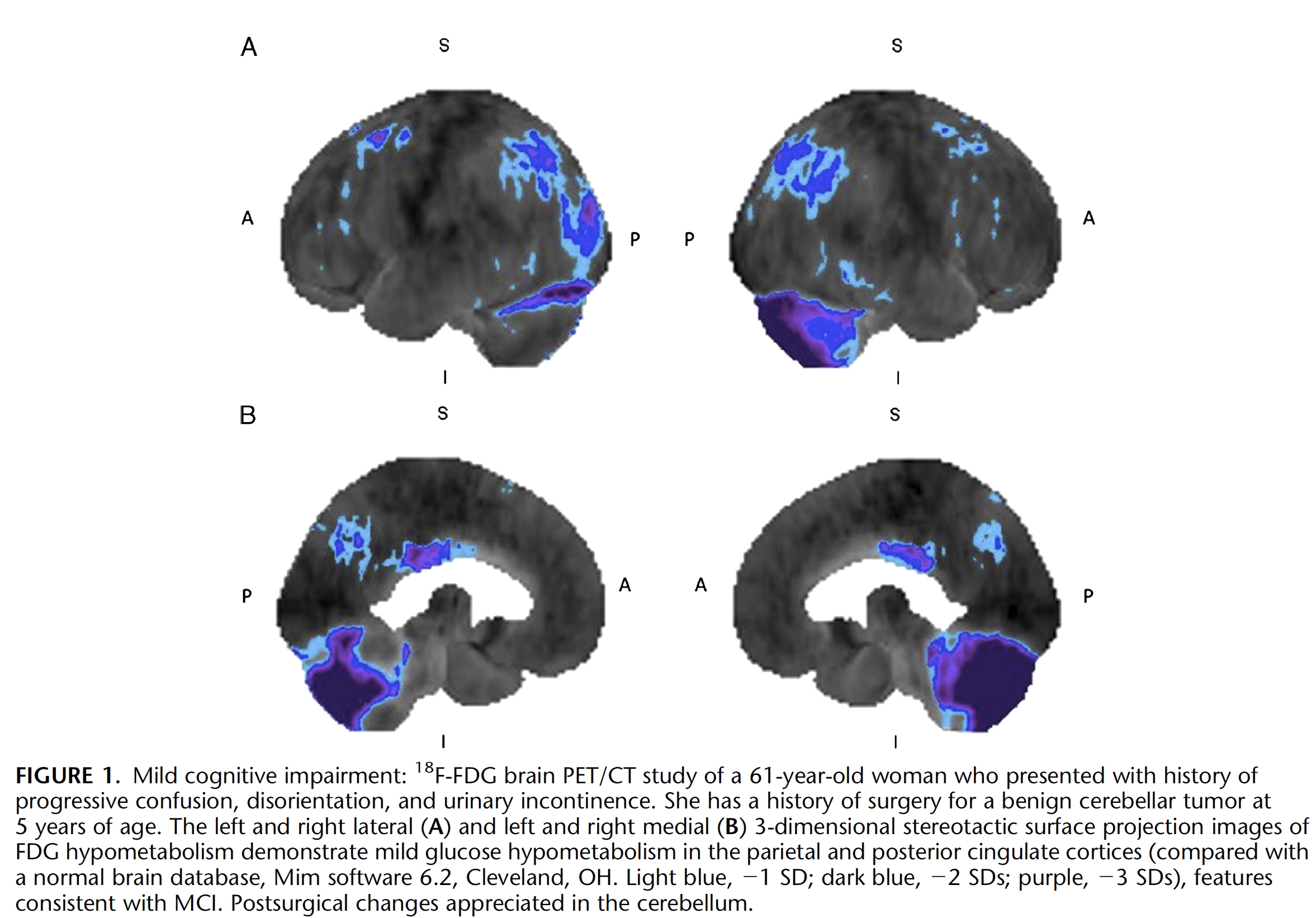 Marcus et al., 2014, Brain PET in the Diagnosis of Alzheimer’s Disease