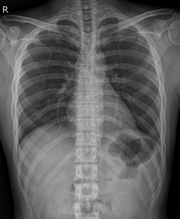 일반촬영 x-ray 엑스레이 갈비뼈,늑골 (Rib series) - AP, PA 촬영방법