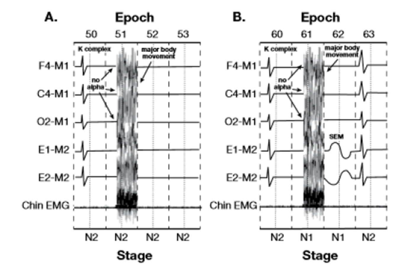수면 단계의 판독-6(sleep stage N2, N3)