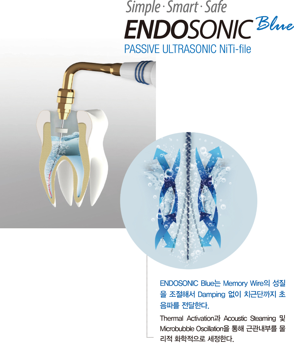 금 인레이 속 깊은 2차충치로 신경치료한 어금니도 오버레이 크라운으로 치료 가능합니다 ;치수괴사,뿌리염증, 근관치료, 러버댐 ...