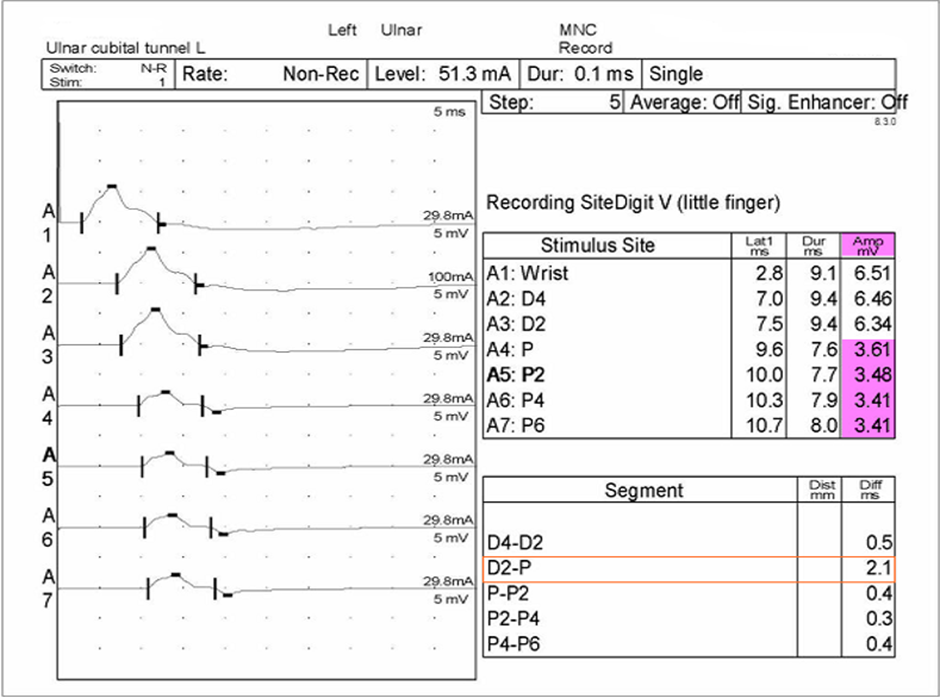 Ulnar - Inching technique, Dorsal ulnar cutaneous (척골신경)