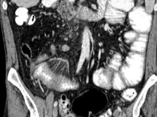 크론병 CT 소견 (crohn disease, comb sign)