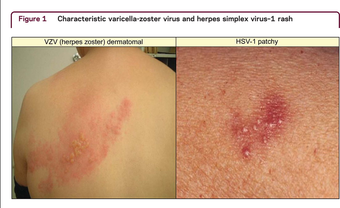 대상포진과 단순포진 이해 - 주요 차이점, 진단 및 관리