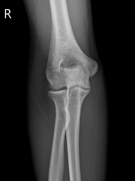 ELBOW(팔꿈치) 방사선 검사 및 특징