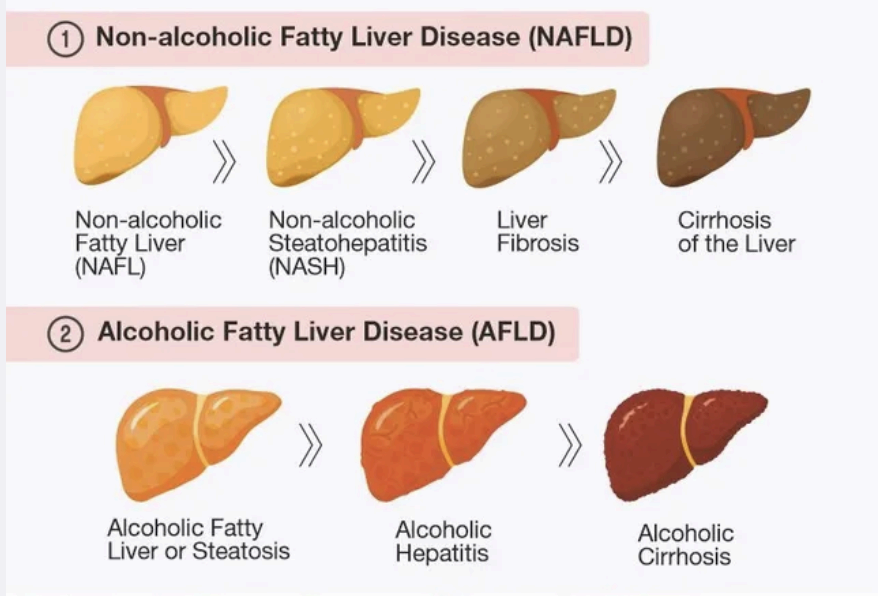 Diffuse liver disease - Fatty liver :: ultrasound study