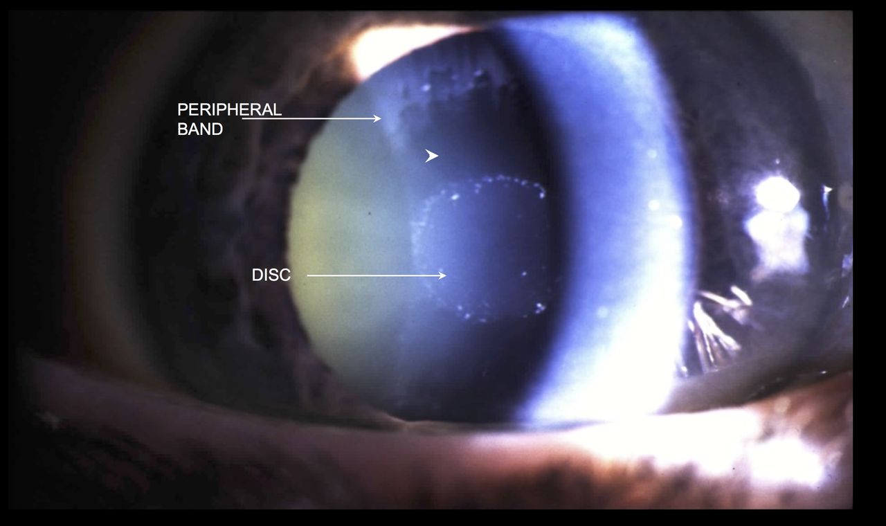 거짓비늘증후군(Pseudoexfoliation syndrome, PES, PXF)의 증상, 검사소견, 백내장 발생