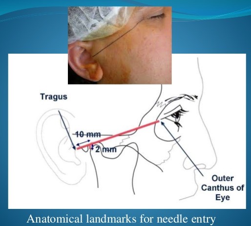 TM joint injection을 위한 anatomy 악관절 TMJ