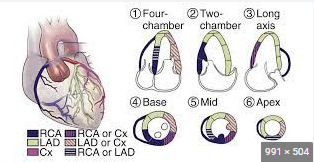 심장초음파 echo RWMA 국소적 벽장애