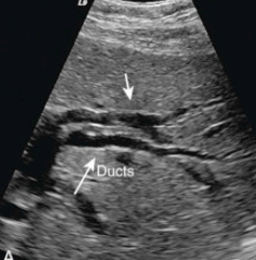 담도폐쇄의 원인 (causes of biliary obstruction) :: ultrasound study