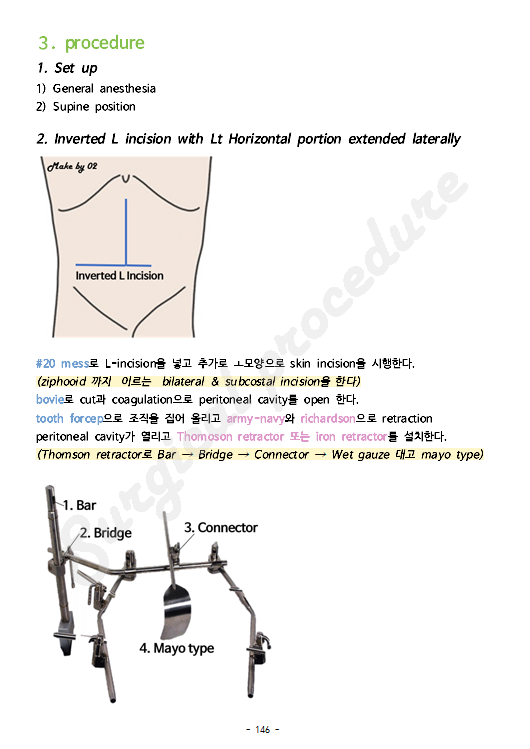 Living Donor Liver Transplantation (LDLT) 생체 간이식술 수술 과정 : 네이버 블로그