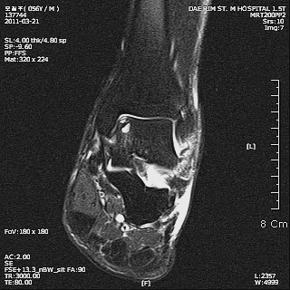 족관절, 슬관절의 박리성 골연골염 (ankle & knee OCD, osteochondral dissecans)