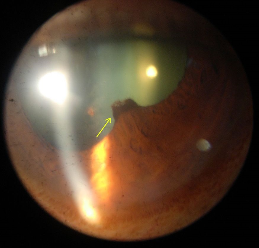 수정체 단백질성 녹내장, lens protein glaucoma, lens particle glaucoma