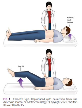 2-2. 피부과가 아닌 통증의학과를 가야하는 ACNES (Abdominal Cutaneous Nerve Entrapment ...