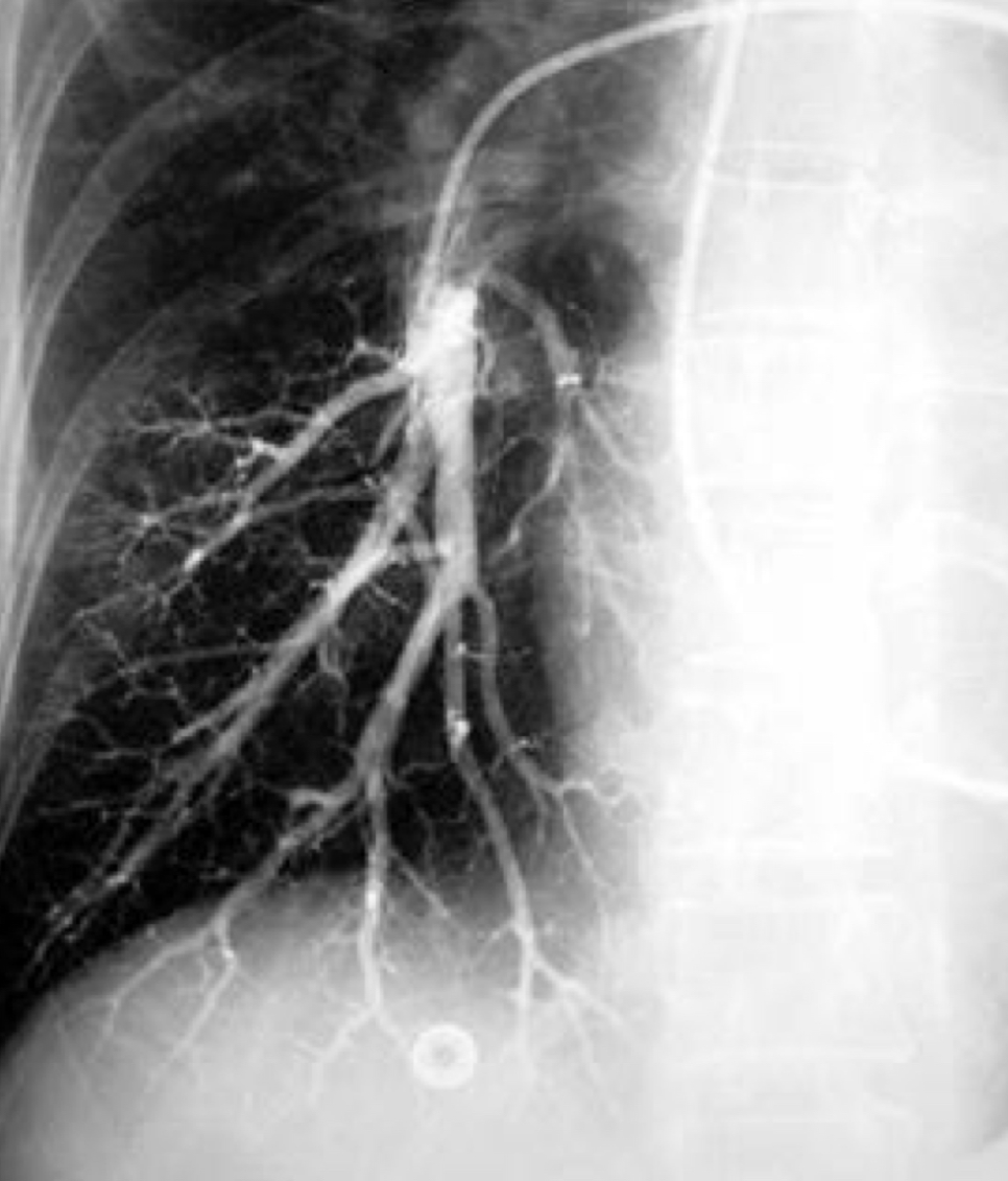 Pulmonary Artery Hypertan sion 폐동맥 고혈압 PAH, - a8
