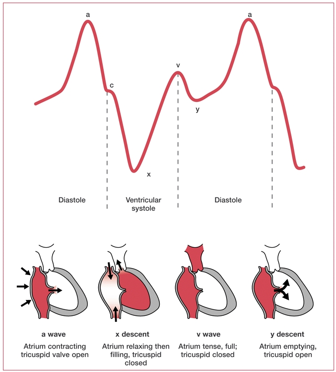 Pulmonary Artery Hypertan sion 폐동맥 고혈압 PAH, - a8