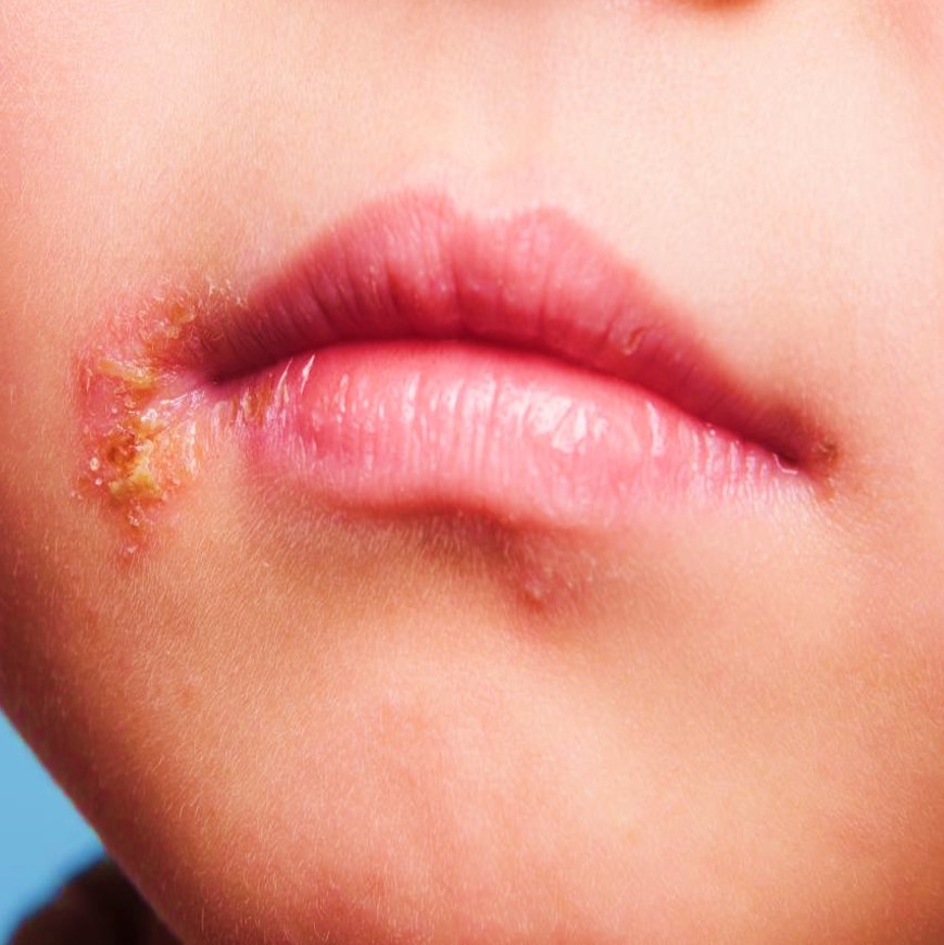 구각염 병원: 구각염 증상을 고민하시나요? 당일 예약 가능!