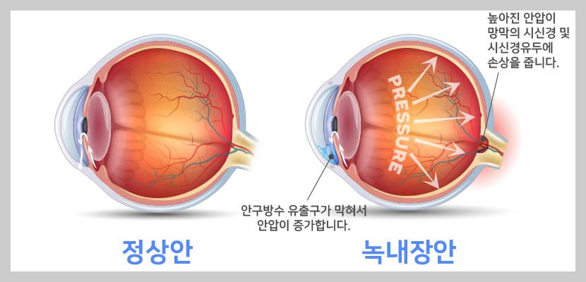 엎드려 자면 어떻게 될까 허리 디스크 있을 때 눕는 자세 만세하는 자세 올바른 수면 자세