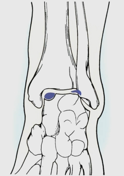 족관절, 슬관절의 박리성 골연골염 (ankle & knee OCD, osteochondral dissecans)
