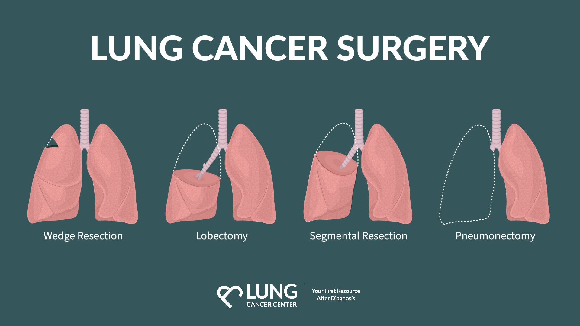 폐 암(Lung Cancer)의 정의, 원인, 검사 및 간호진단