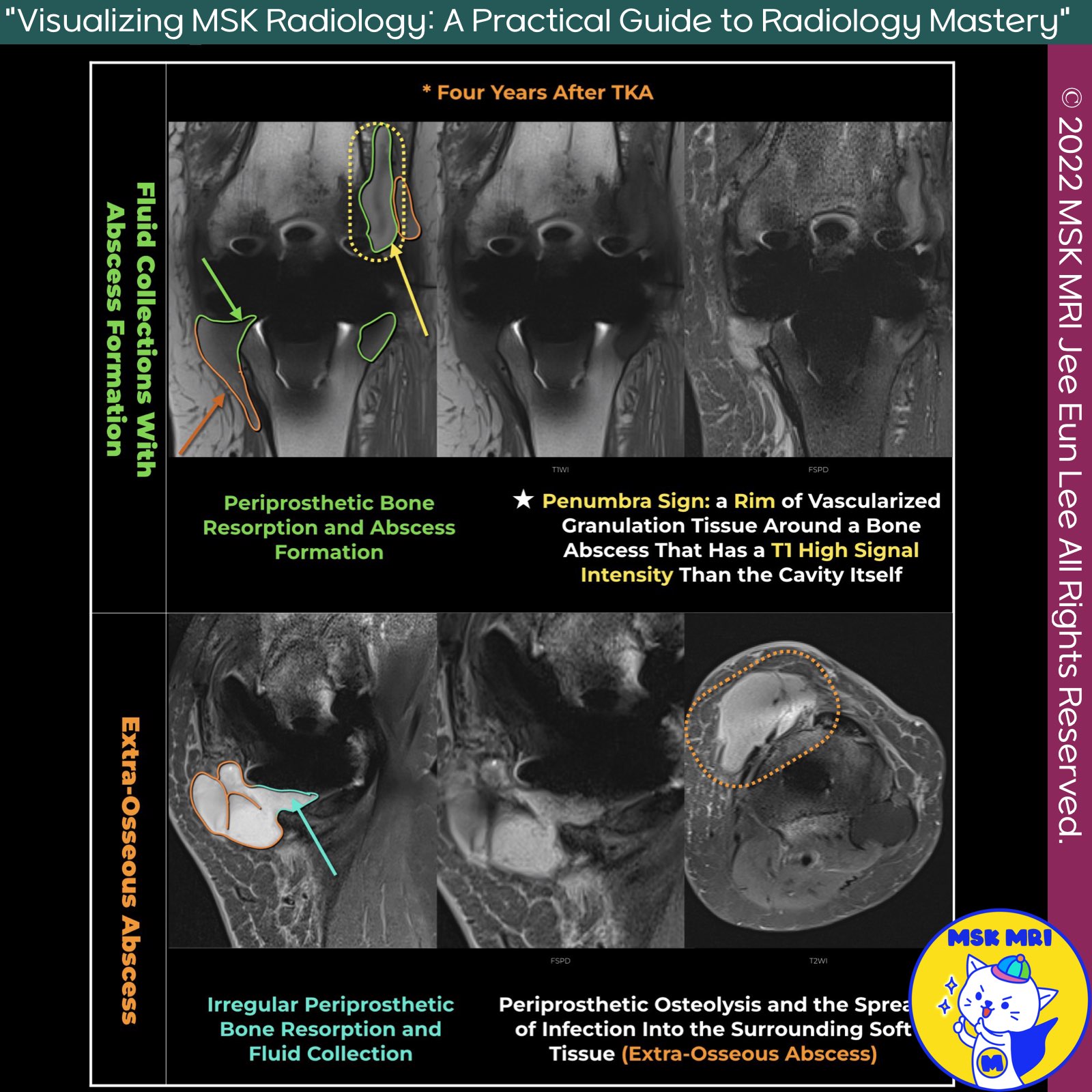 (Fig 5-D.17) Periprosthetic Infection - Abscess