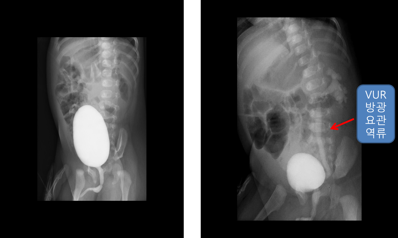 소아 요로감염 영상진단법 방광요도조영술(VCUG)