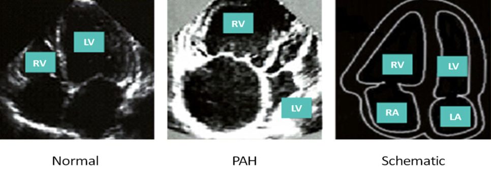 Pulmonary Artery Hypertan sion 폐동맥 고혈압 PAH, - a8