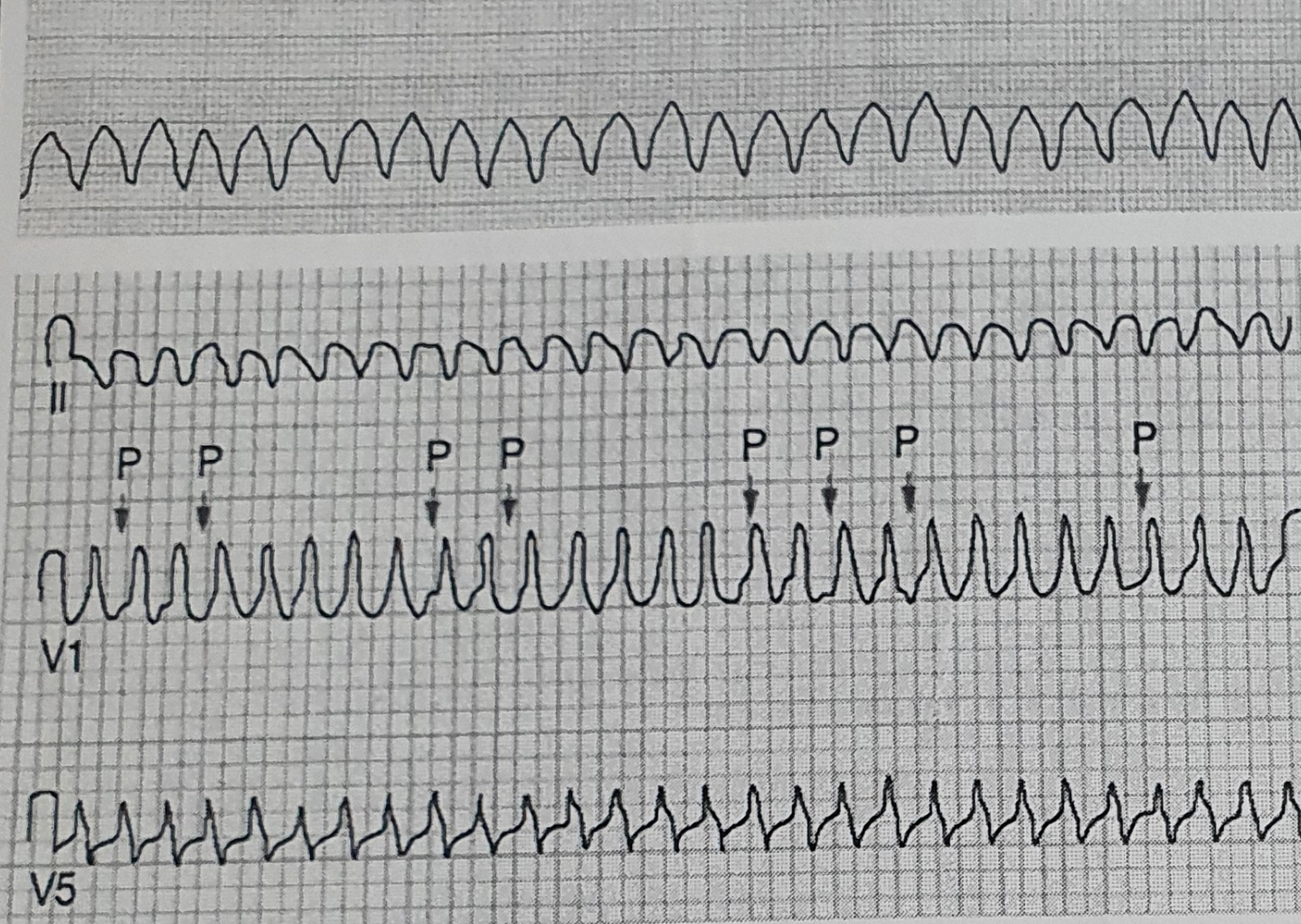 응급실 간호사라면 꼭! 알아야 하는 EKG rhythm(Asystole, PEA, VF, Pulseless VT, PSVT, A ...