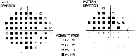 Humphrey VF 시야검사 정상 및 비정상, 녹내장 평가