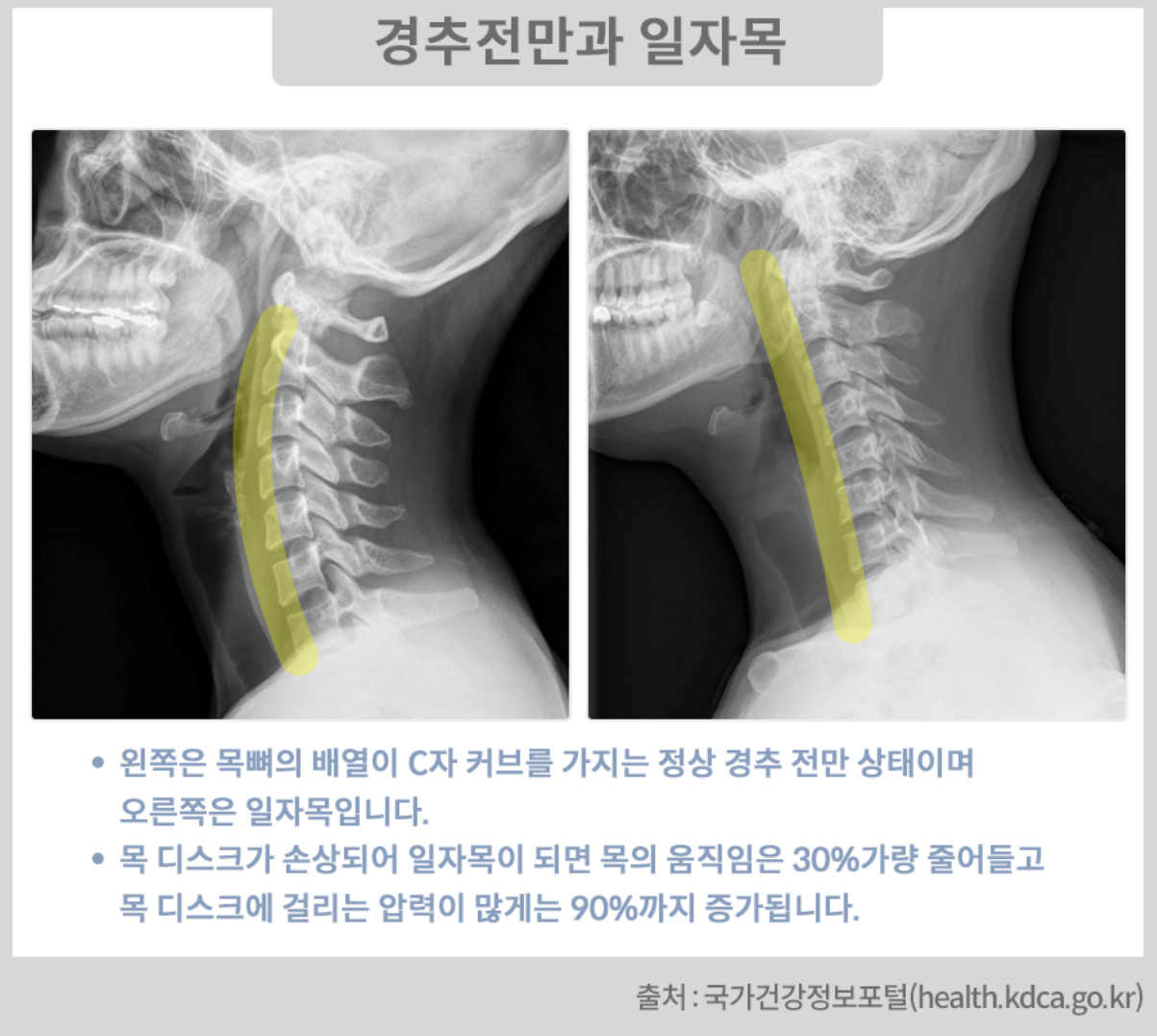 현대인의 국민질병 목디스크 증상과 예방 방법 건강 쉼표