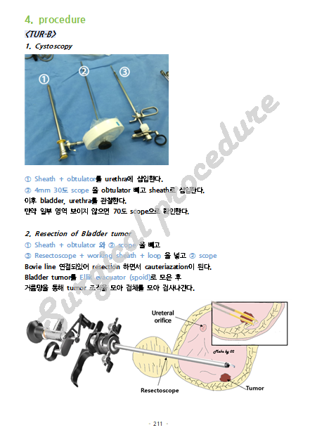 URO / TUR-B, TUR-P (Transurethralresection bladder, Prostate) 경요도 방광 ...