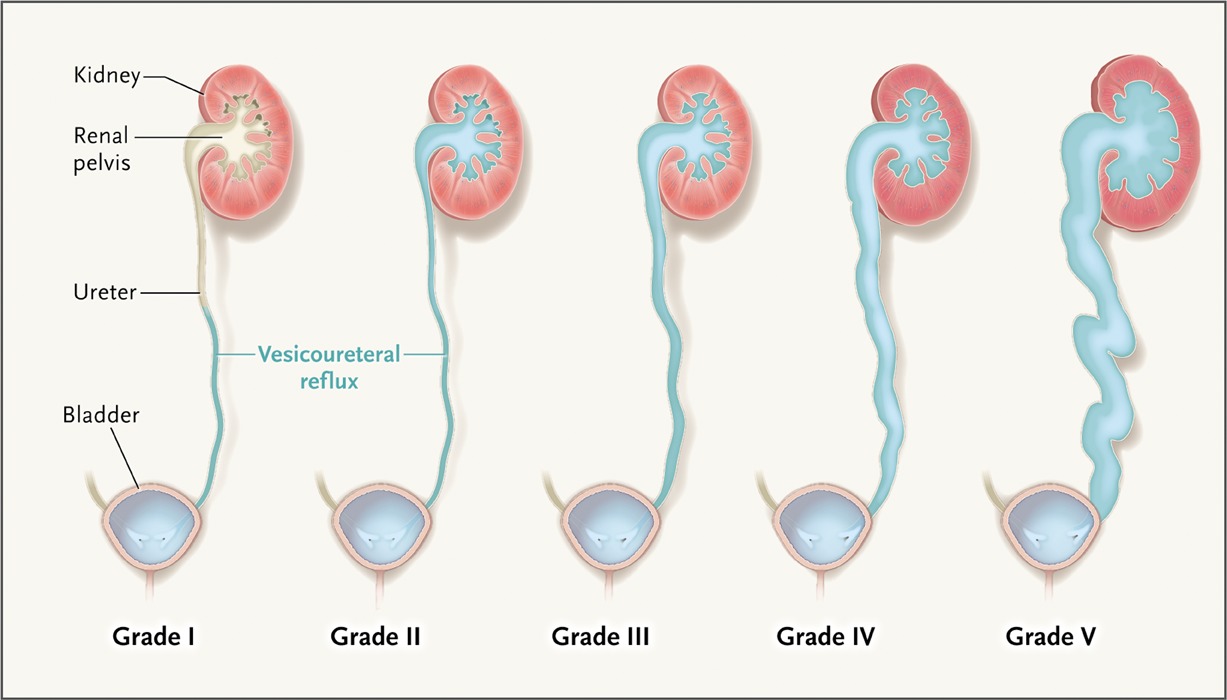소아 요로감염 영상진단법 방광요도조영술(VCUG)
