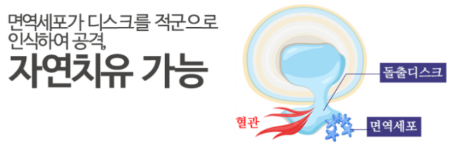 담배 피면 디스크에 걸릴 수 있다